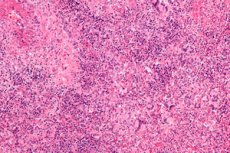 Granulomatosis con poliangitis: síntomas, diagnóstico, tratamiento y ...